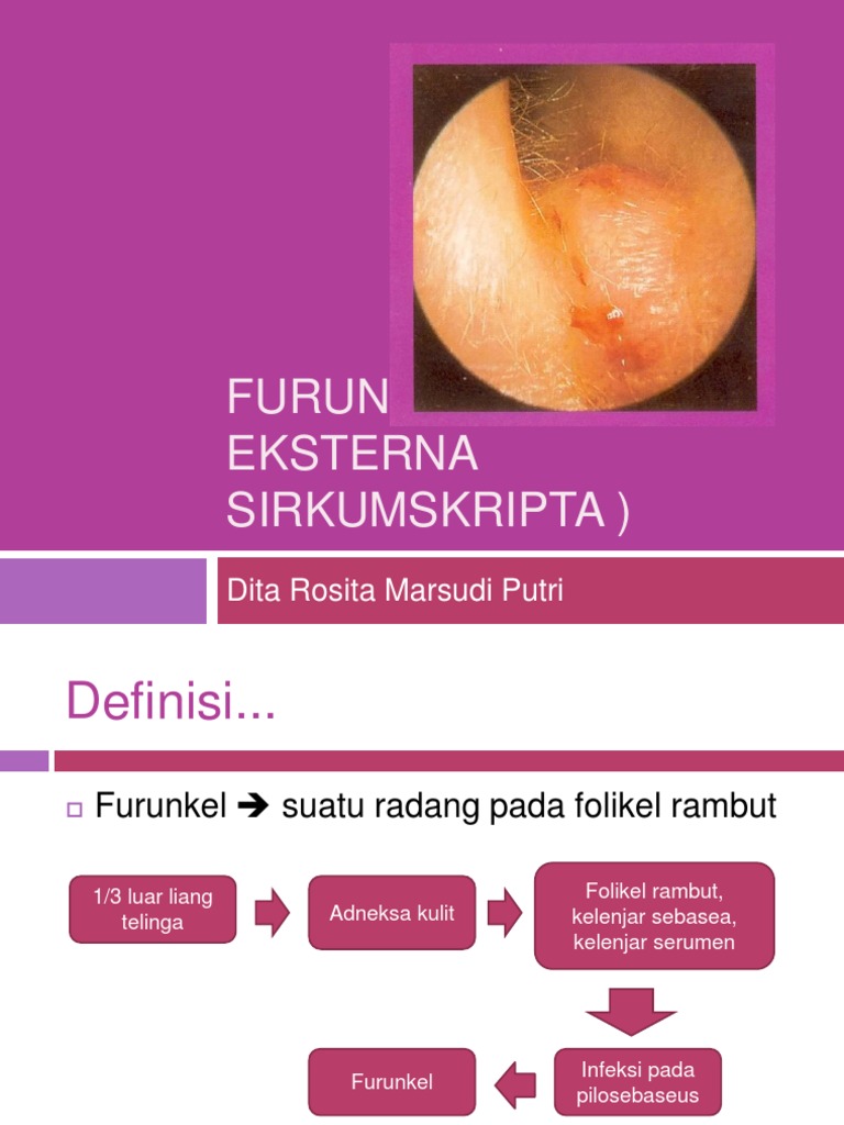 Furunkel ( Otitis Eksterna Sirkumskripta )