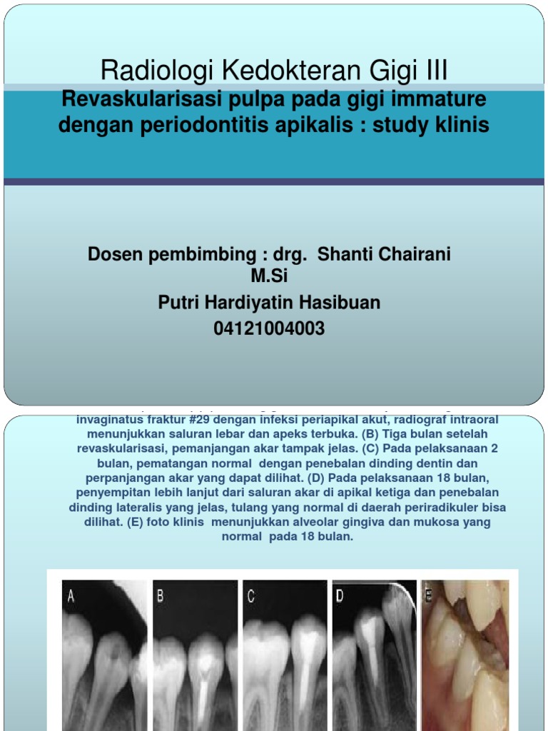 RKG Revaskularisasi Pulpa Gigi Immature DGN Periodontitis Apikalis | PDF