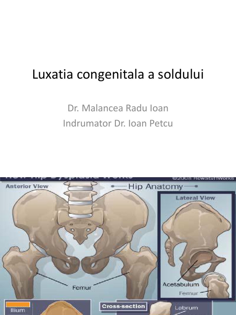 49.luxatia Congenitala A Soldului - DR - Malancea Radu | PDF
