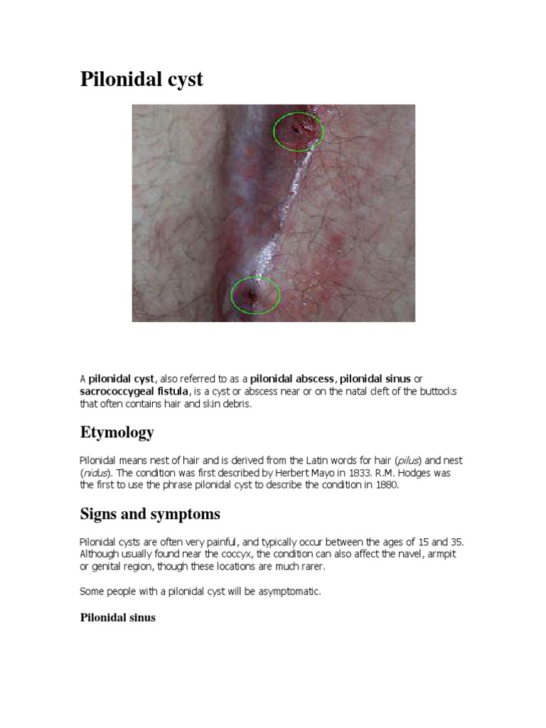 Pilonidal Cyst: Etymology | PDF | Health Sciences | Medical Specialties