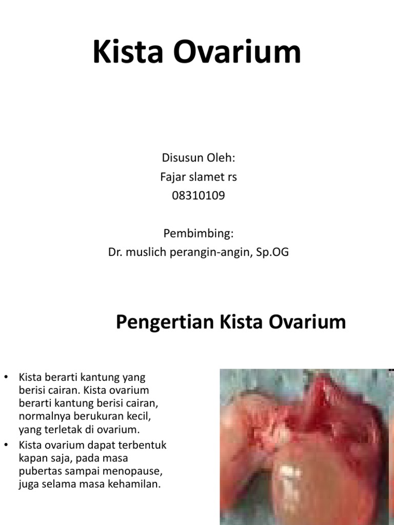 Kista Ovarium | PDF