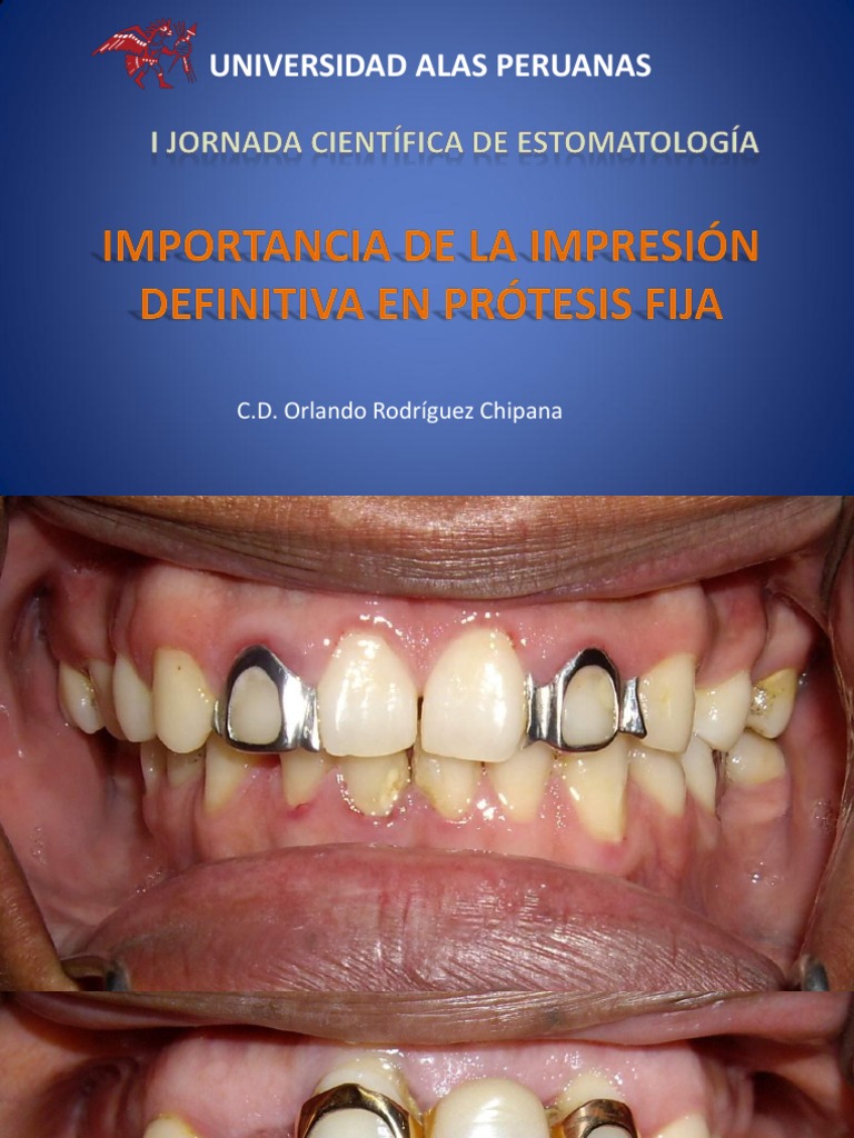 Importancia de La Impresión Definitiva en Prótesis Fija | PDF | Diente ...