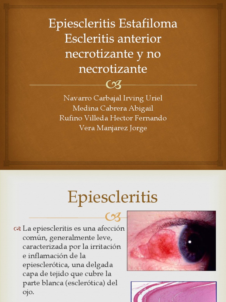 Exposicion equipo 1 : Epiescleritis,Estafiloma, Tipos de Escleritis ...