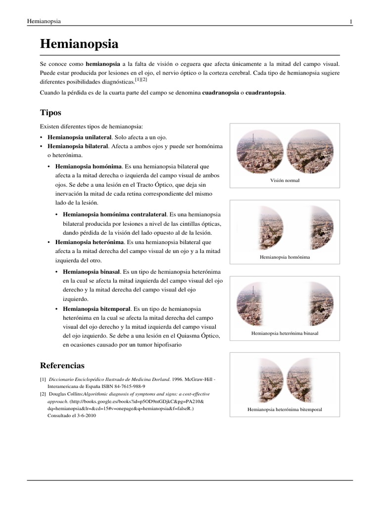 Tipos de Hemianopsia y Definición | PDF | Percepción visual | Ojo
