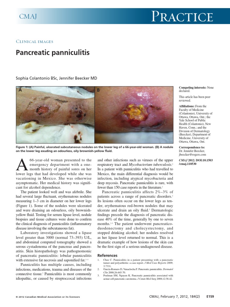 Practice: Pancreatic Panniculitis | PDF | Pancreatic Cancer | Cutaneous ...