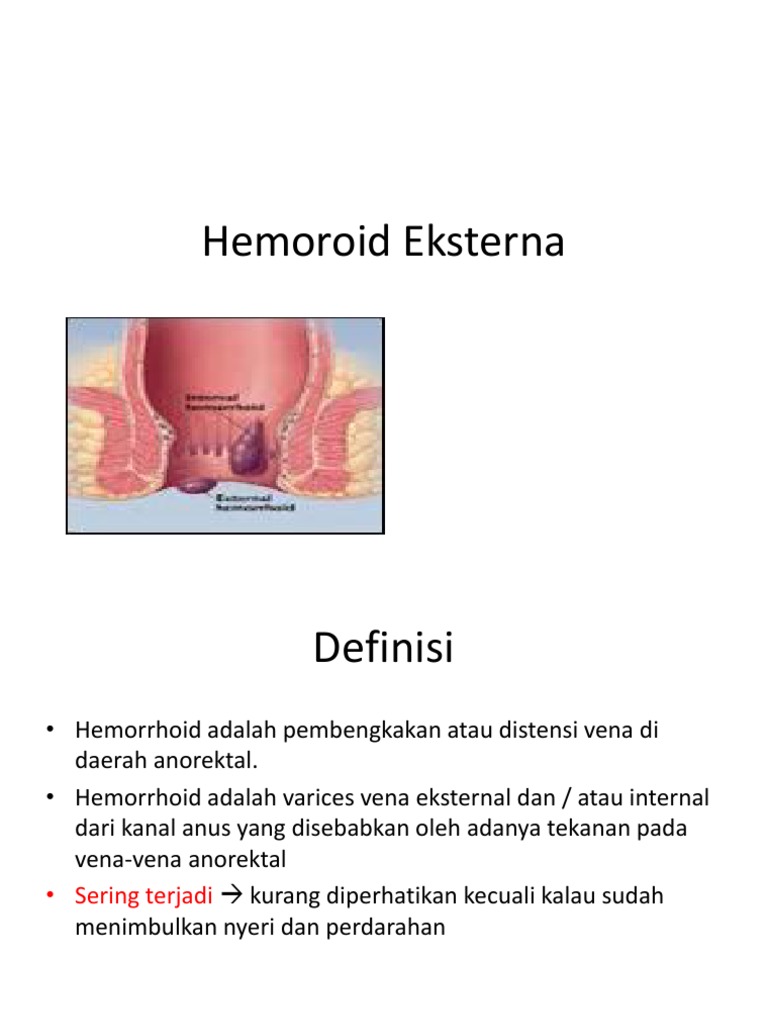 Hemoroid Eksterna | PDF