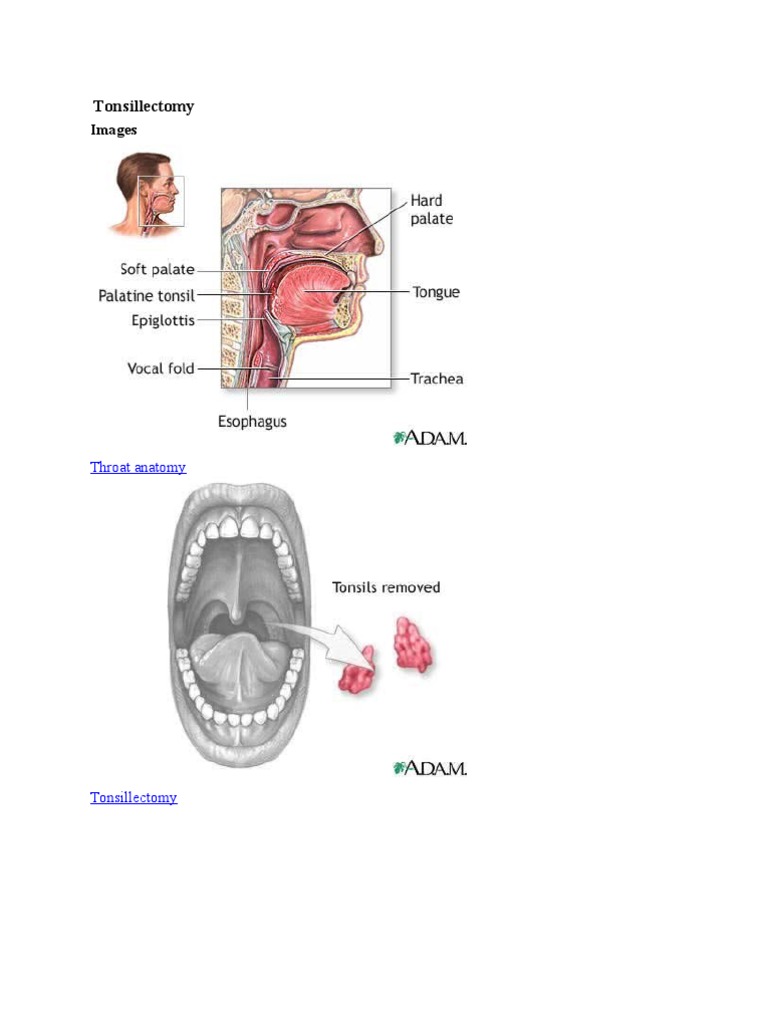 Tonsillectomy | Surgery | Diseases And Disorders