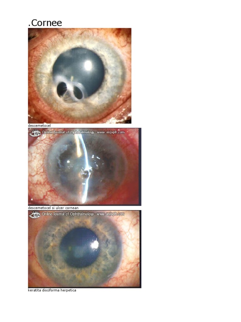 Atlas Oftalmo 1 | PDF | Cornea | Cataract