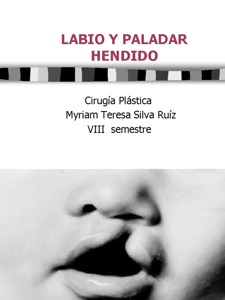Clasificación de fisuras labiopalatinas | PDF | Anatomía humana ...