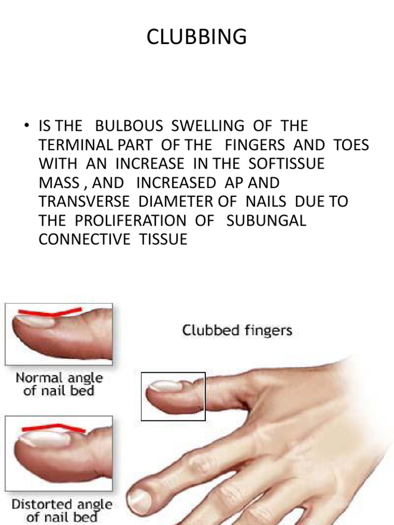 Clubbing | PDF | Lung | Medical Specialties