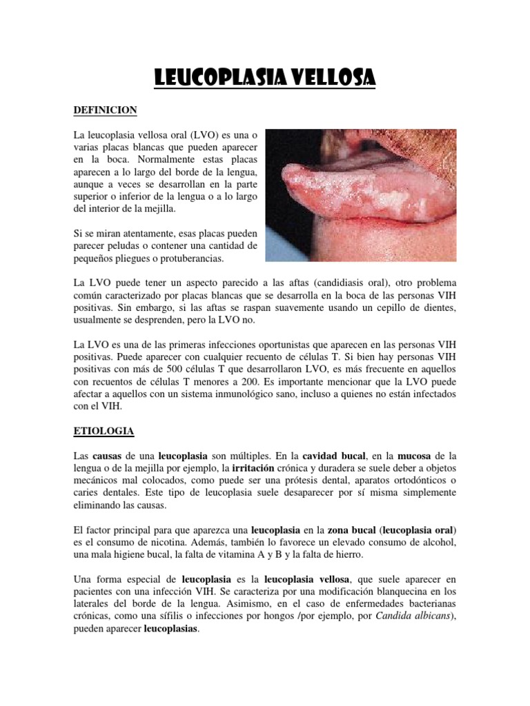 Leucoplasia Vellosa | PDF | Candidiasis | Diente humano