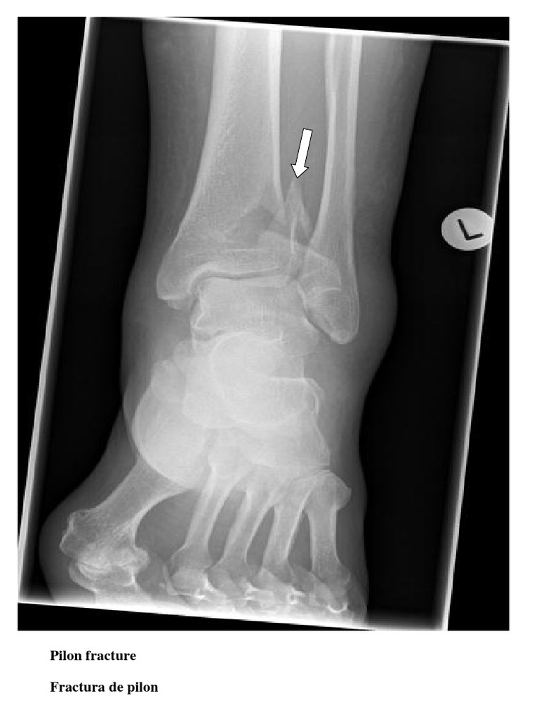 Radiografii Picior | PDF