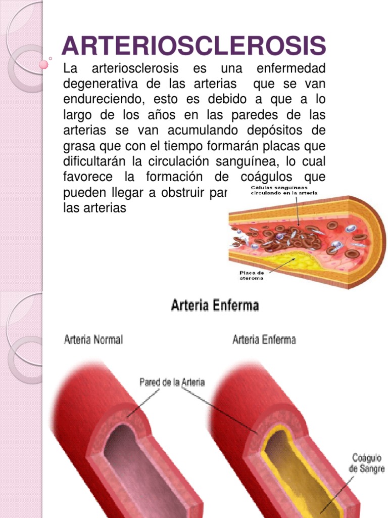 Arteriosclerosis | PDF | Aterosclerosis | Angiología