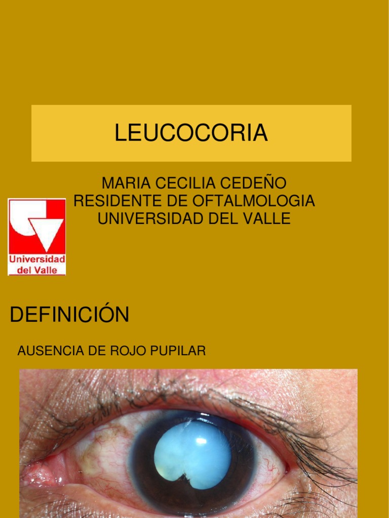 LEUCORIA | PDF | Catarata | Oftalmología