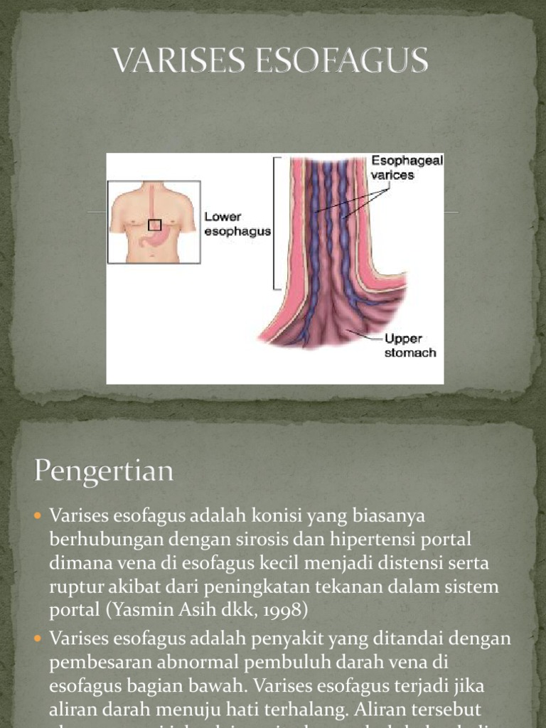 Penanganan Varises Esofagus dan Komplikasinya | PDF