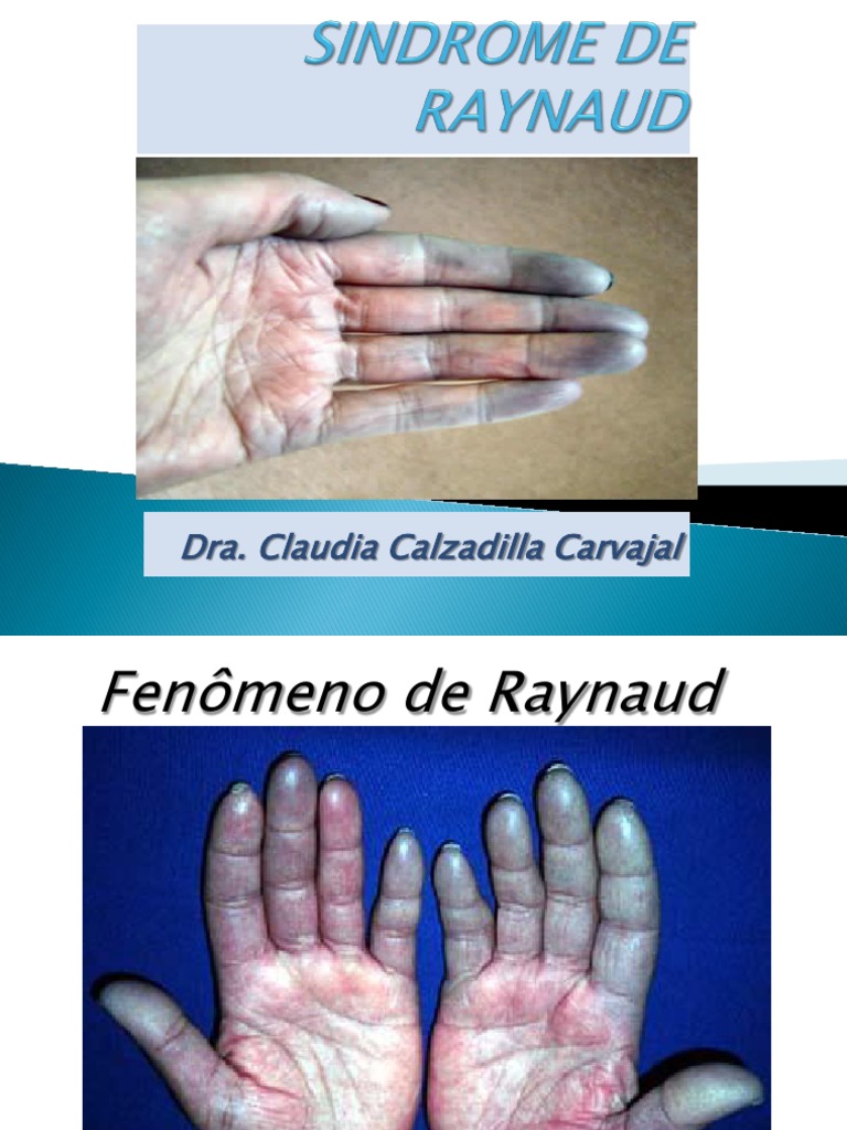 # 3 Fenómeno de Raynaud | PDF | Especialidades Medicas | Medicina CLINICA