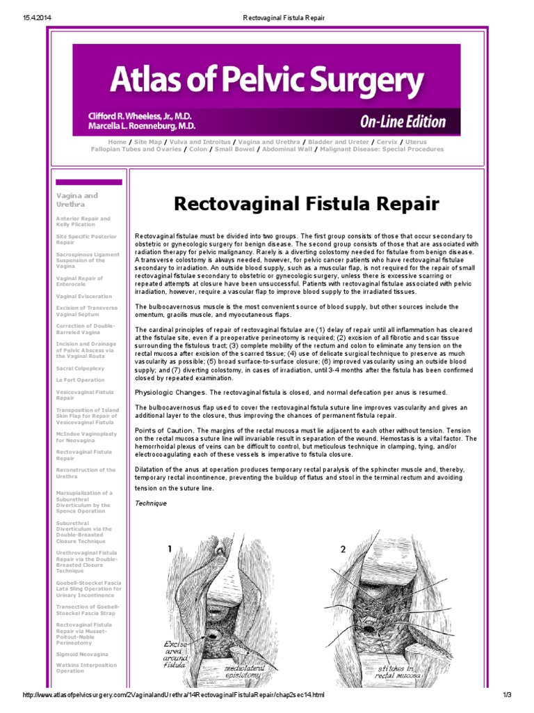 Rectovaginal Fistula Repair Vagina Rectum