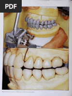 Implant Loading Protocols Guide | PDF | Dental Implant | Bone