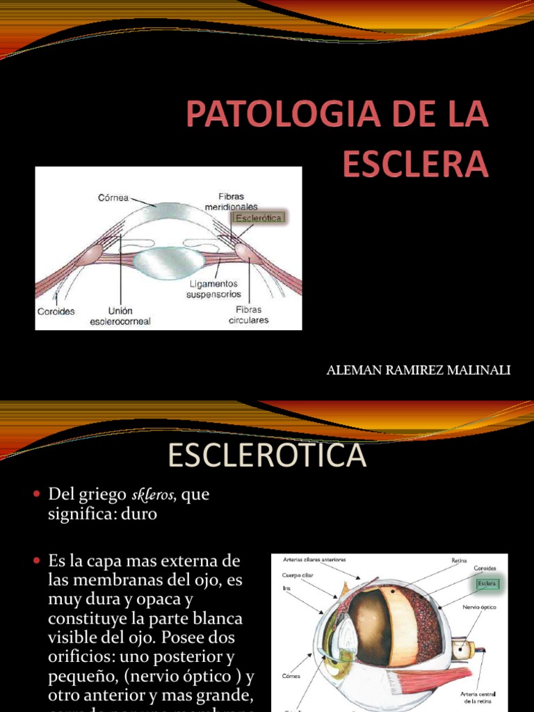 Patologia de La Esclera | Ojo | Órganos sensoriales