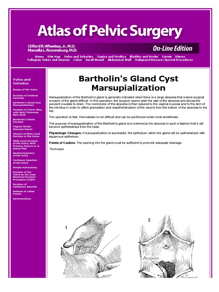 Bartholin's Gland Cyst Marsupialization | PDF | Vagina | Surgery
