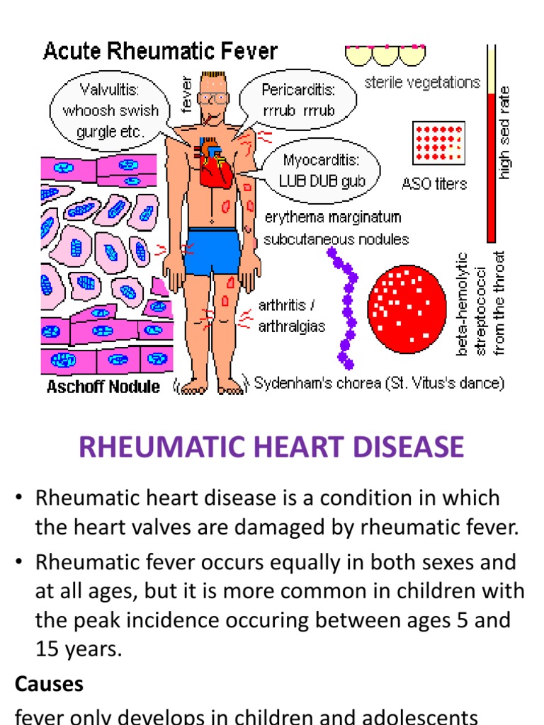 RHEUMATIC HEART DISEASE | Heart Valve | Anatomy