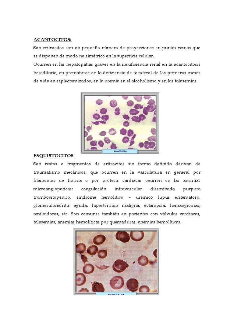 ACANTOCITOS | PDF | Anemia | Nucleo celular