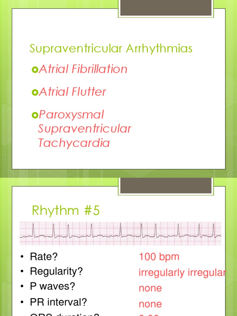 Atrial Flutter | Cardiac Arrhythmia (17 views)