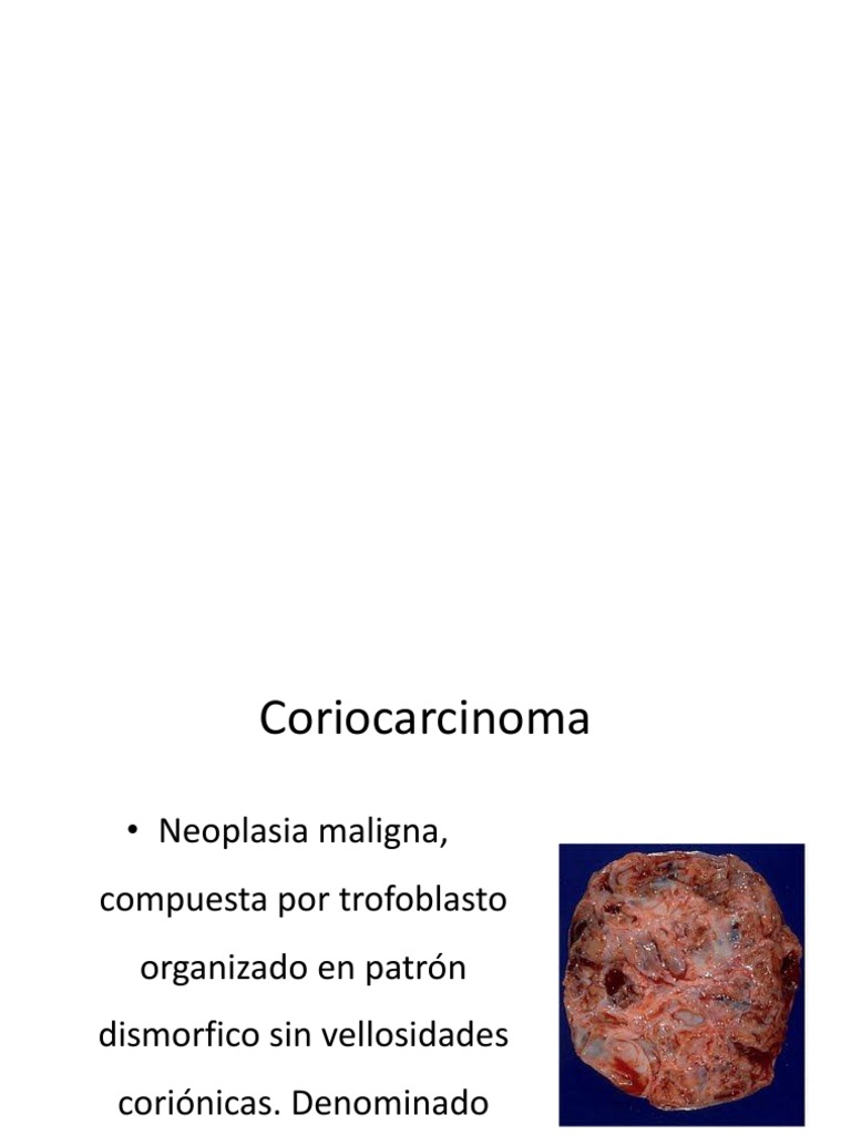 Coriocarcinoma Final | PDF | Implantación (embrión humano) | El embarazo