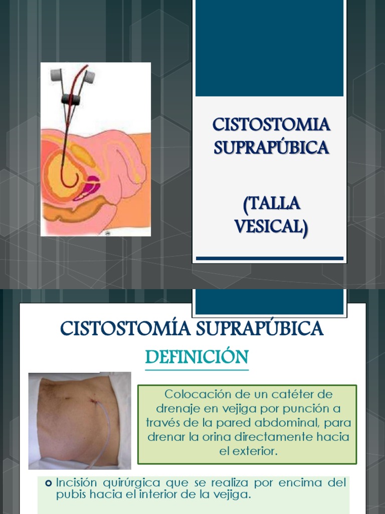 Procedimiento quirúrgico de cistostomía suprapúbica: indicaciones ...
