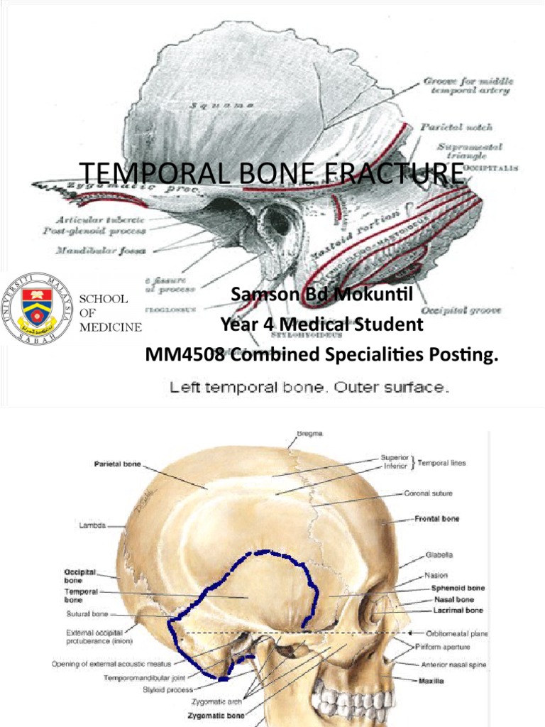 Temporal Bone Fracture | PDF | Skeletal System | Ear