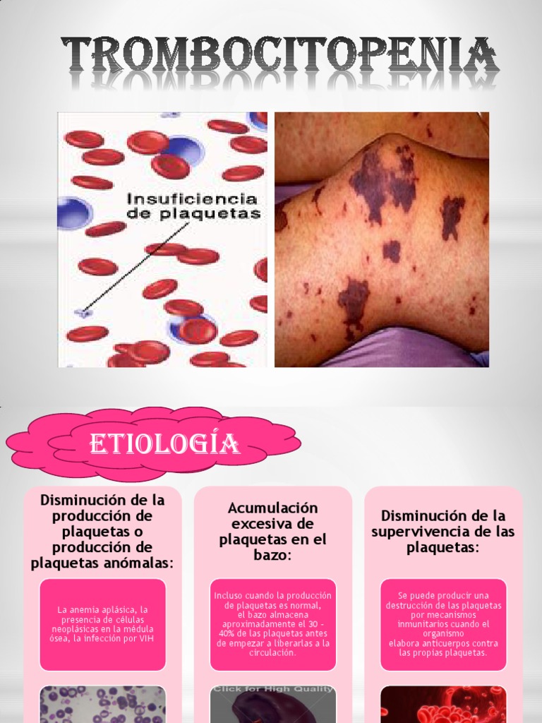 TROMBOCITOPENIA | PDF | Plaqueta | Leucemia