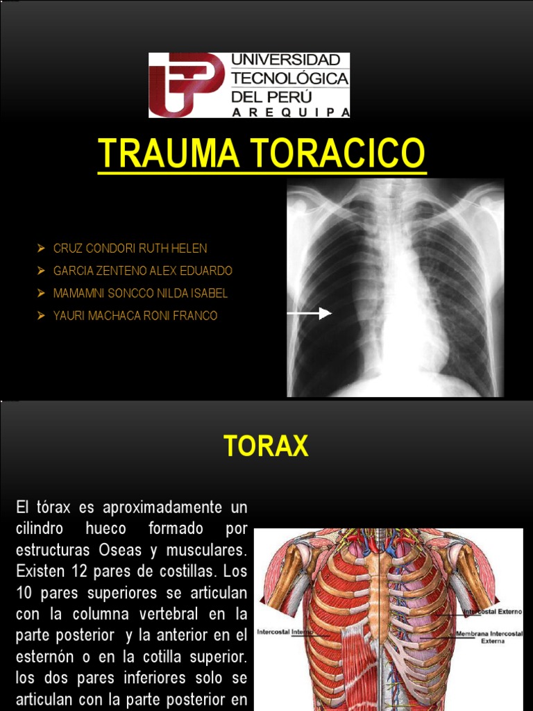 Trauma Toracico Expo | Tórax | Sistema respiratorio