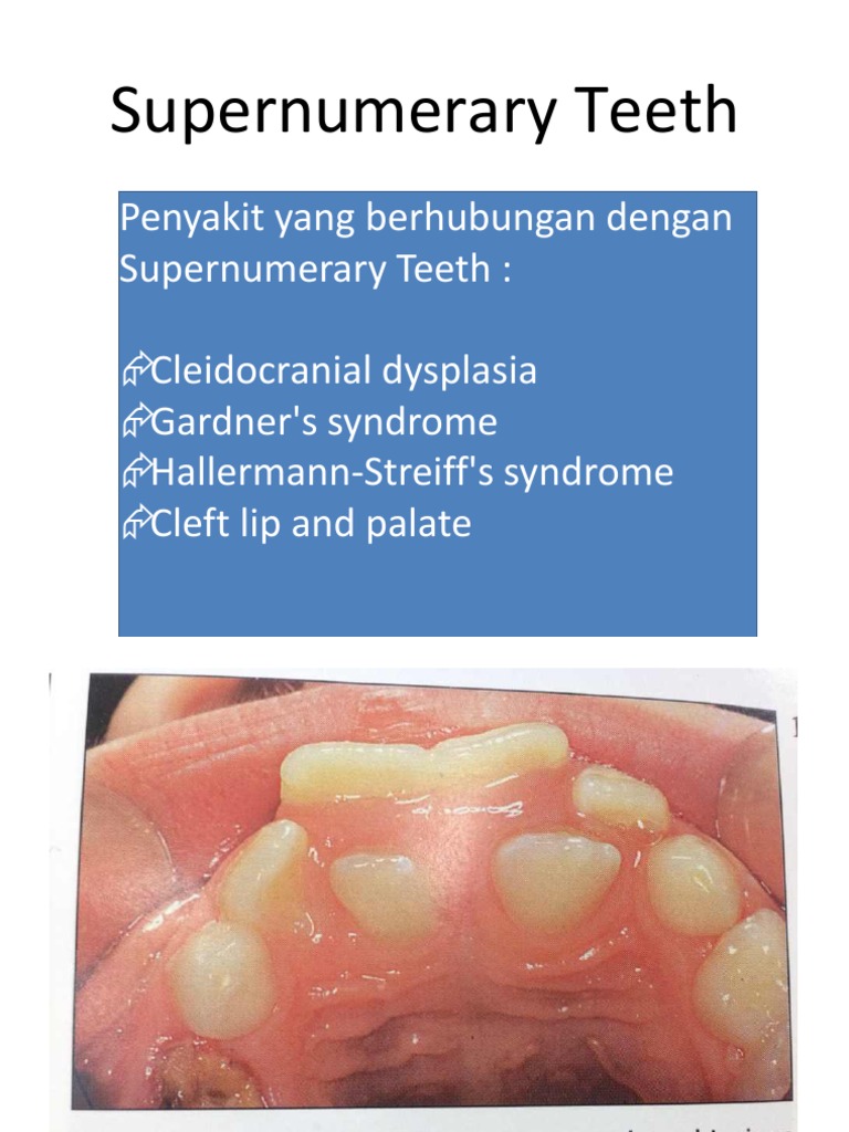 Supernumerary Teeth | PDF