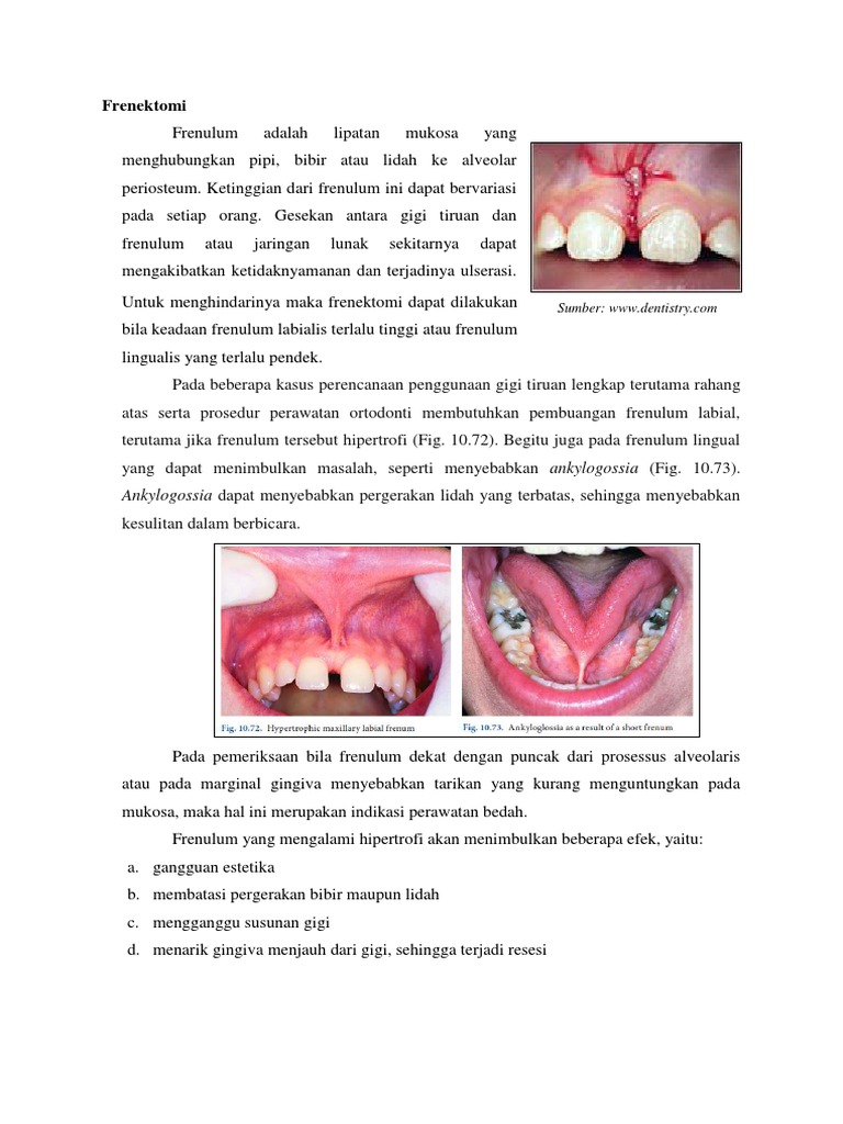 Frenektomi | PDF