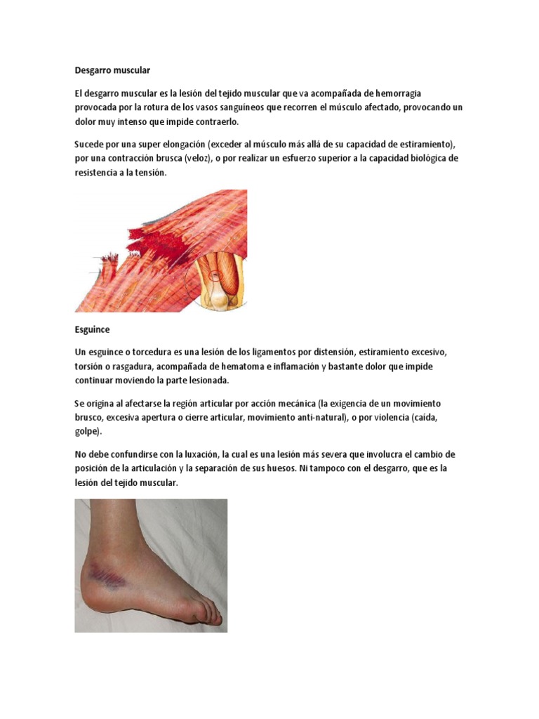 Desgarro Muscular (2) | Deportes | Lesión