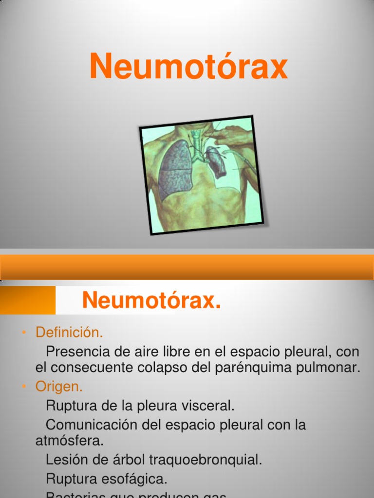 7 Neumotorax | PDF