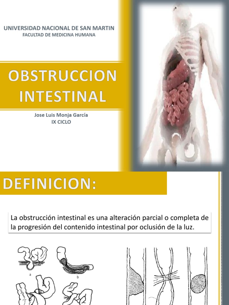 Obstruccion Intestinal | Intestino grueso | Abdomen