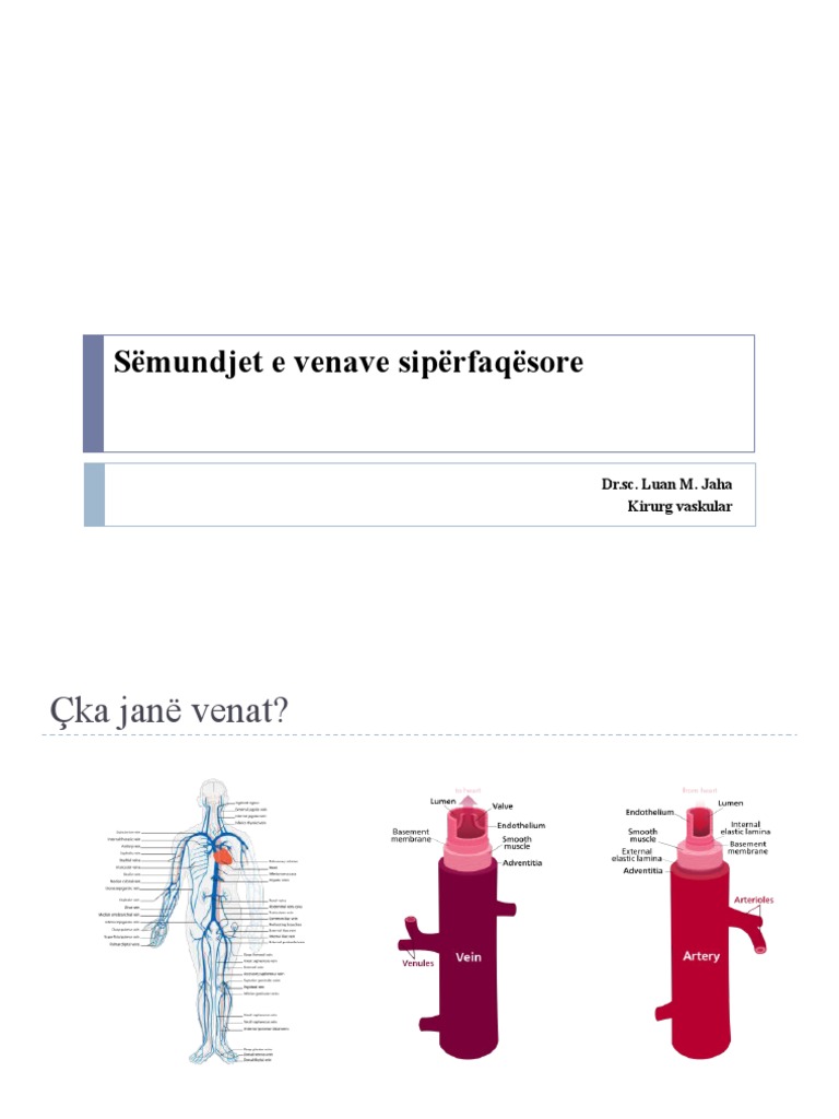 Venat Varikoze Dhe Komplikacionet e Tyre | PDF