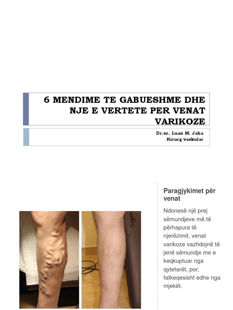 6 Gabimet Dhe 1 e Vertete Per Venat Varikoze | PDF