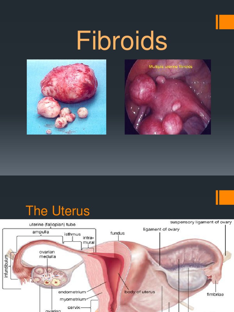 Fibroids Powerpoint Pdf Uterus Sexual Anatomy
