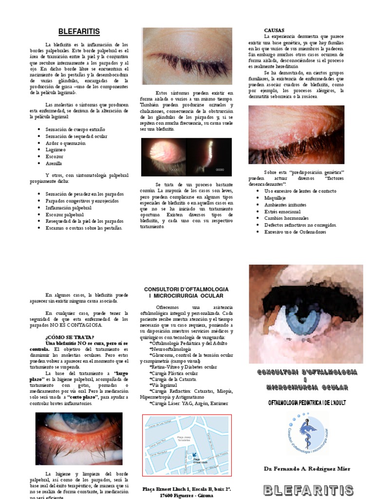 BLEFARITIS | Oftalmología | Medicina
