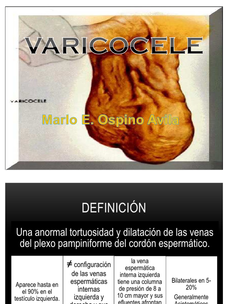 Varicocele | PDF