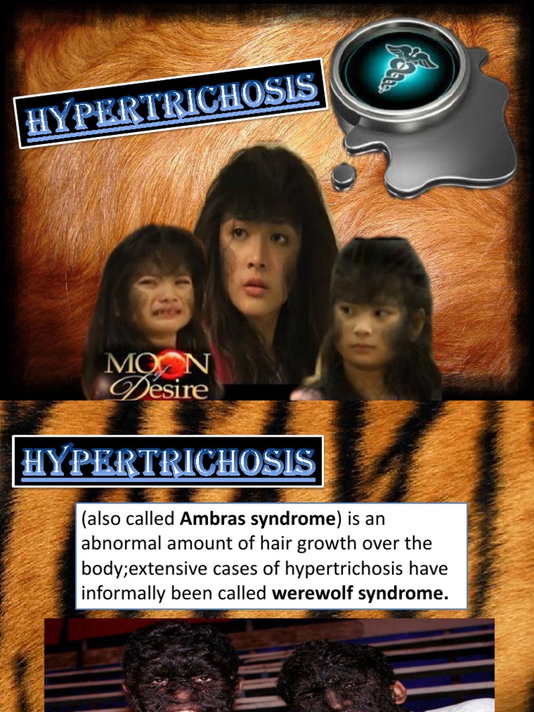 Understanding Hypertrichosis | PDF