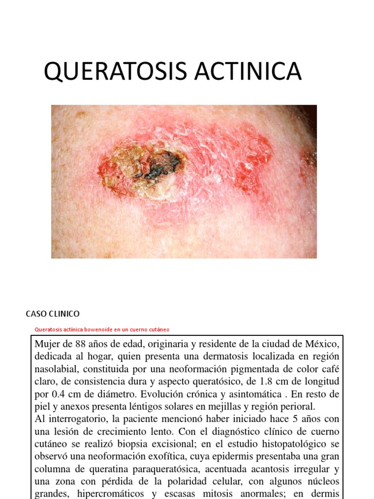 Queratosis actinica