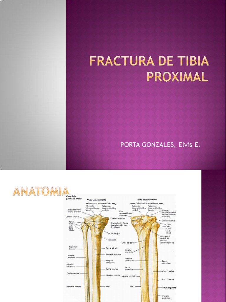 Fractura de Tibia Proximal | PDF | Rodilla | Sistema esquelético