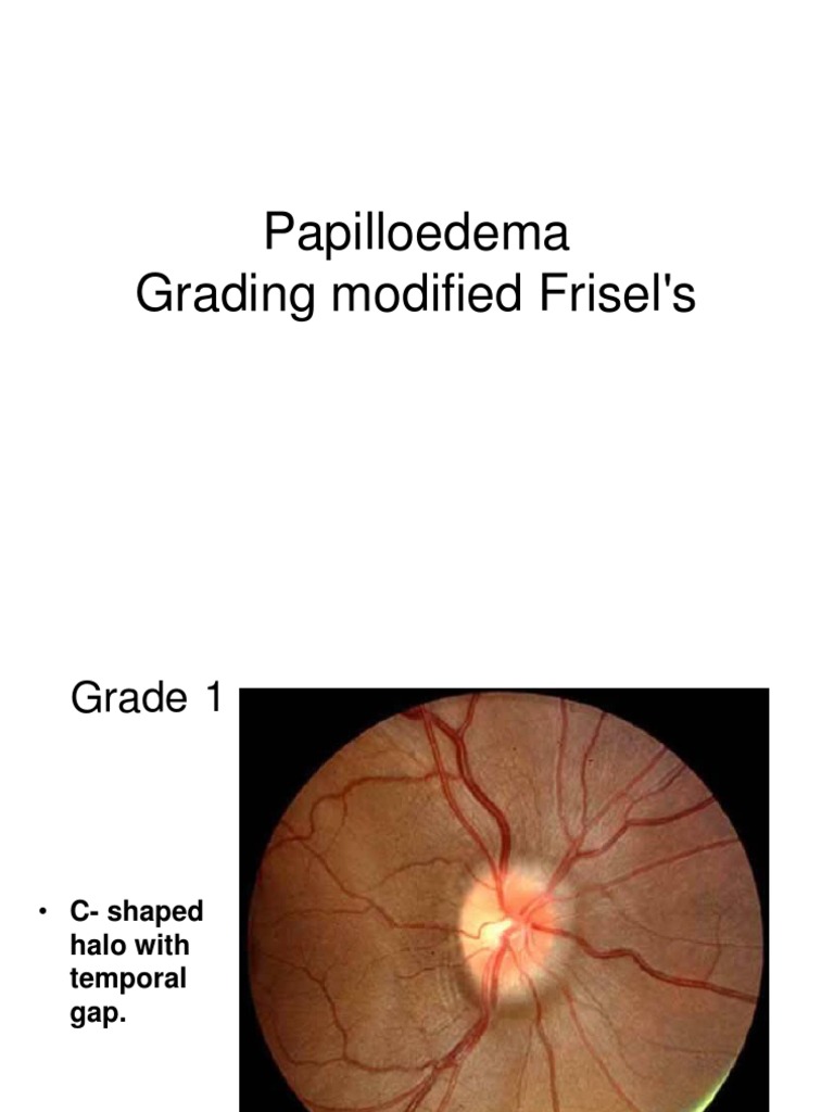 Papilledema Grading