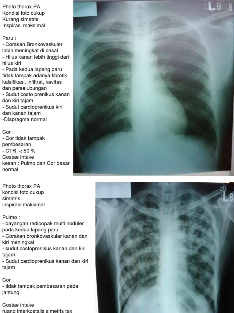 Peningkatan Corakan Bronkovaskuler Paru | PDF