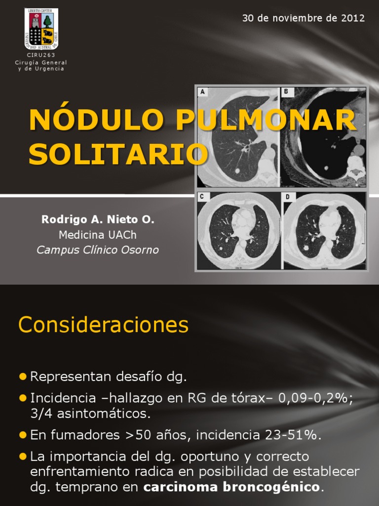Nódulo Pulmonar Solitario 1 | PDF | Cáncer de pulmón | Cáncer