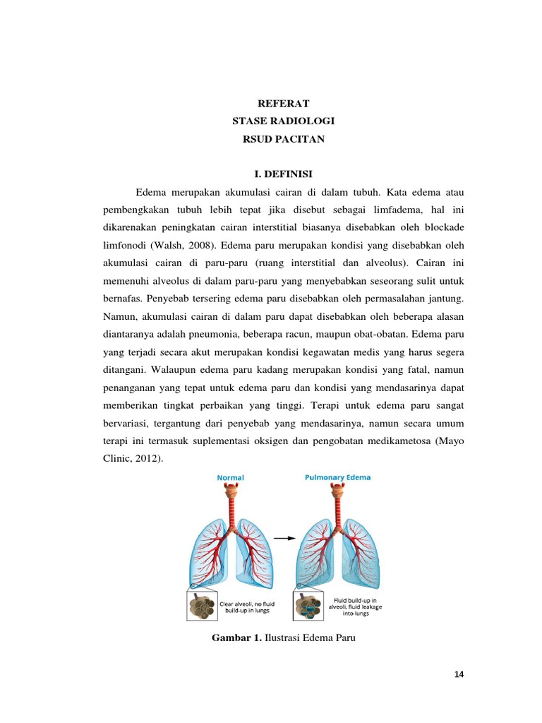 Edema Paru | PDF