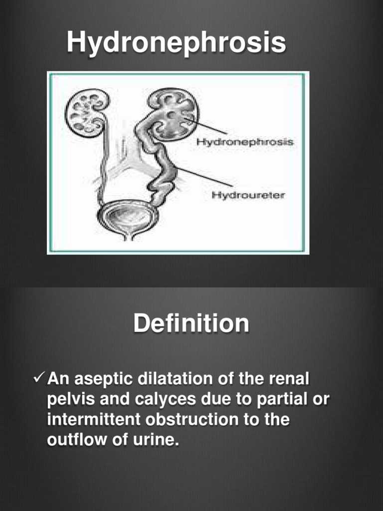 Hydronephrosis | Kidney | Urology